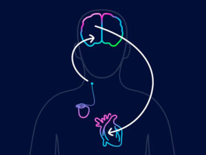 Successful Implant of Barostim Baroreflex Activation Therapy for the ...
